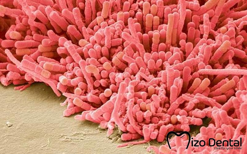Hình dạng con sâu răng dưới kính hiển vi trông như thế nào? - Mizo Dental