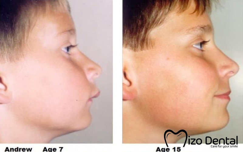 Mewing là gì, răng hô có nên tập Mewing để giảm bớt hô? - Mizo Dental